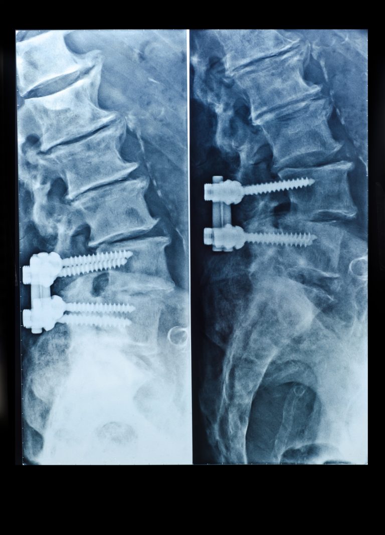 Failed Back Surgery and Chiropractic - Dr. Martin Schmaltz